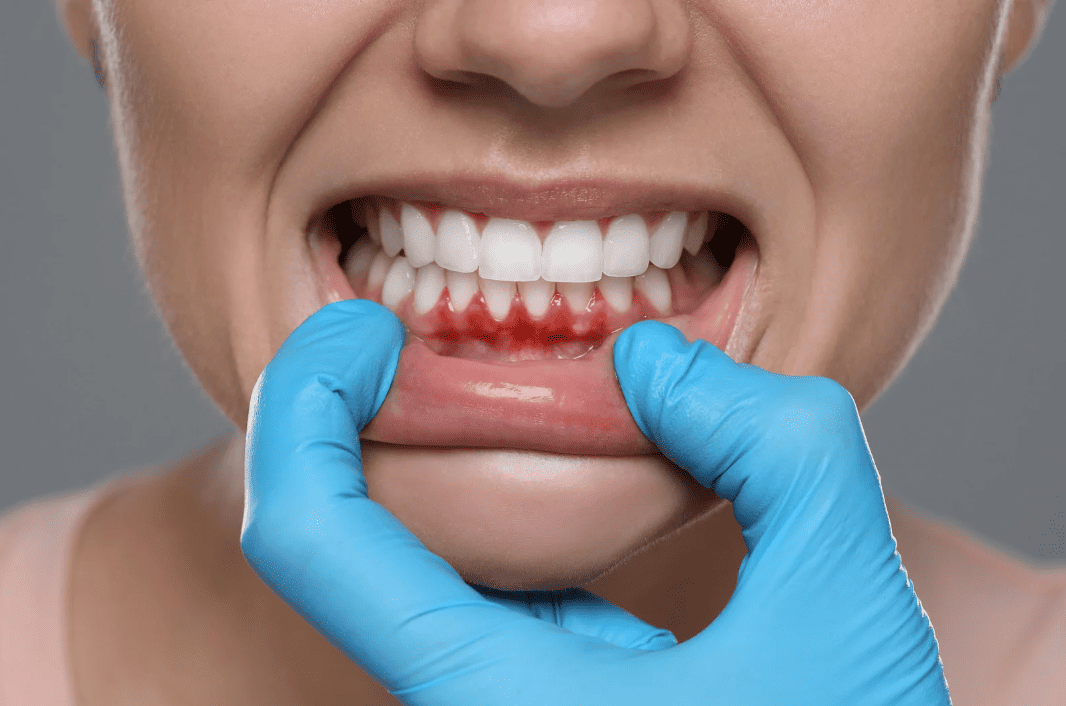 Dental Abscess: The Causes, Symptoms, Treatments & Prevention - Smith ...