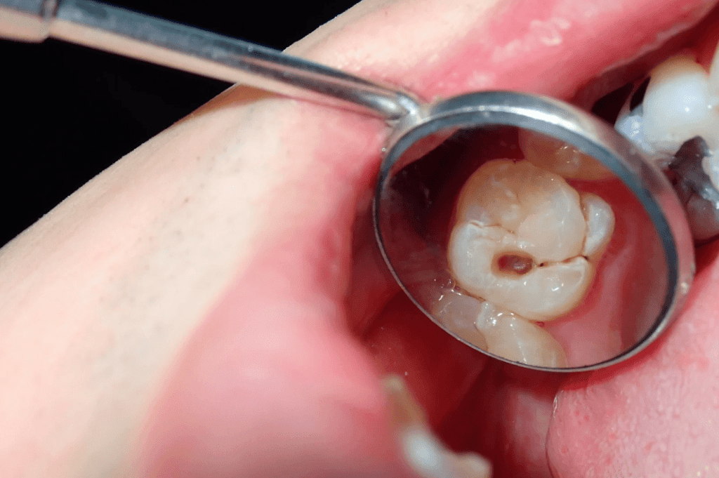 How to Handle Tooth Decay? 5 Stages from Early Symptoms to Severe Tooth ...