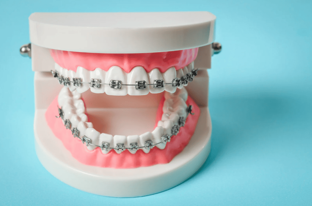 Braces Orthodontics: Costs, Process, Types of Braces, and FAQs - Smith ...