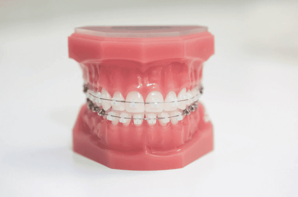 Braces Orthodontics: Costs, Process, Types of Braces, and FAQs - Smith ...
