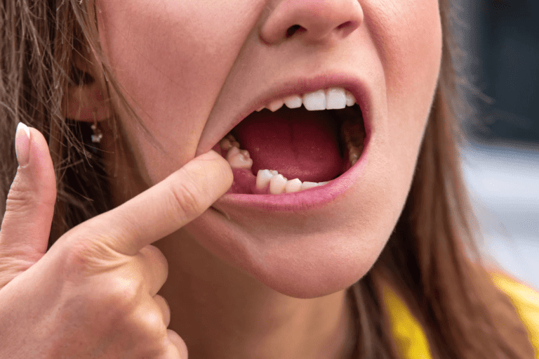 How to Fix Missing Teeth: Causes and Treatments - Smith & Jain Dentists