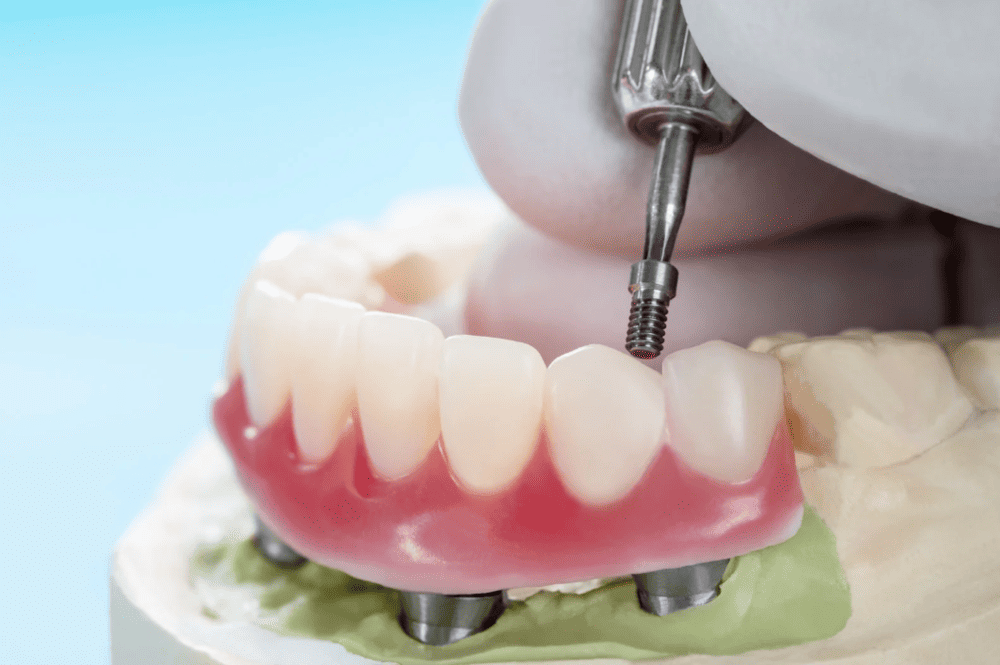 [2026 Dental Implant Guide] The Implant Process, Side Effects, Success ...