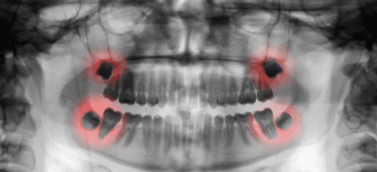 Wisdom Teeth Impaction and Inflammation: Symptoms, Causes, and ...
