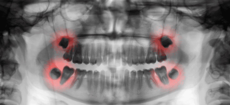Wisdom Teeth Impaction and Inflammation: Symptoms, Causes, and ...