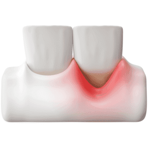Gum Recession: Causes, Treatments, and Prevention - Smith and Jain Dentists