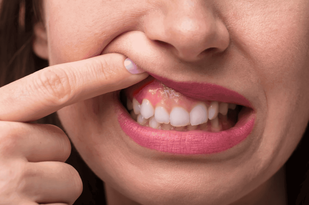 Gum Recession: Causes, Treatments, and Prevention - Smith and Jain Dentists